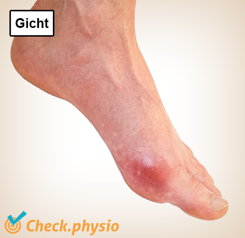 Ursache, Symptome & Behandlung | Gicht - Physiotest.ch